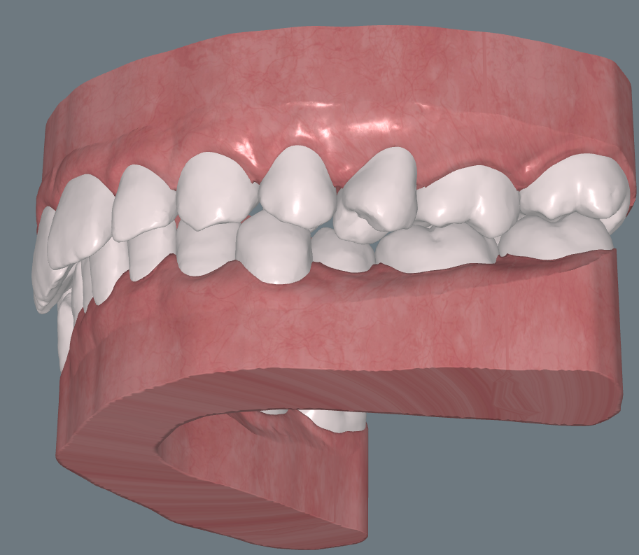 Posterior Bite Ramps – CandidPro