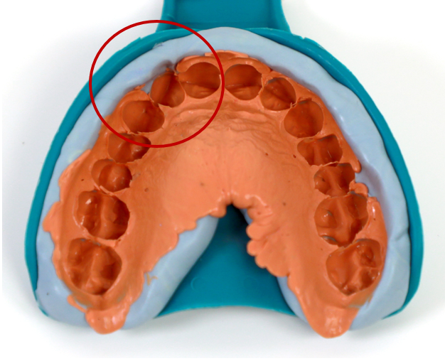 Common Issues with Impressions – CandidPro