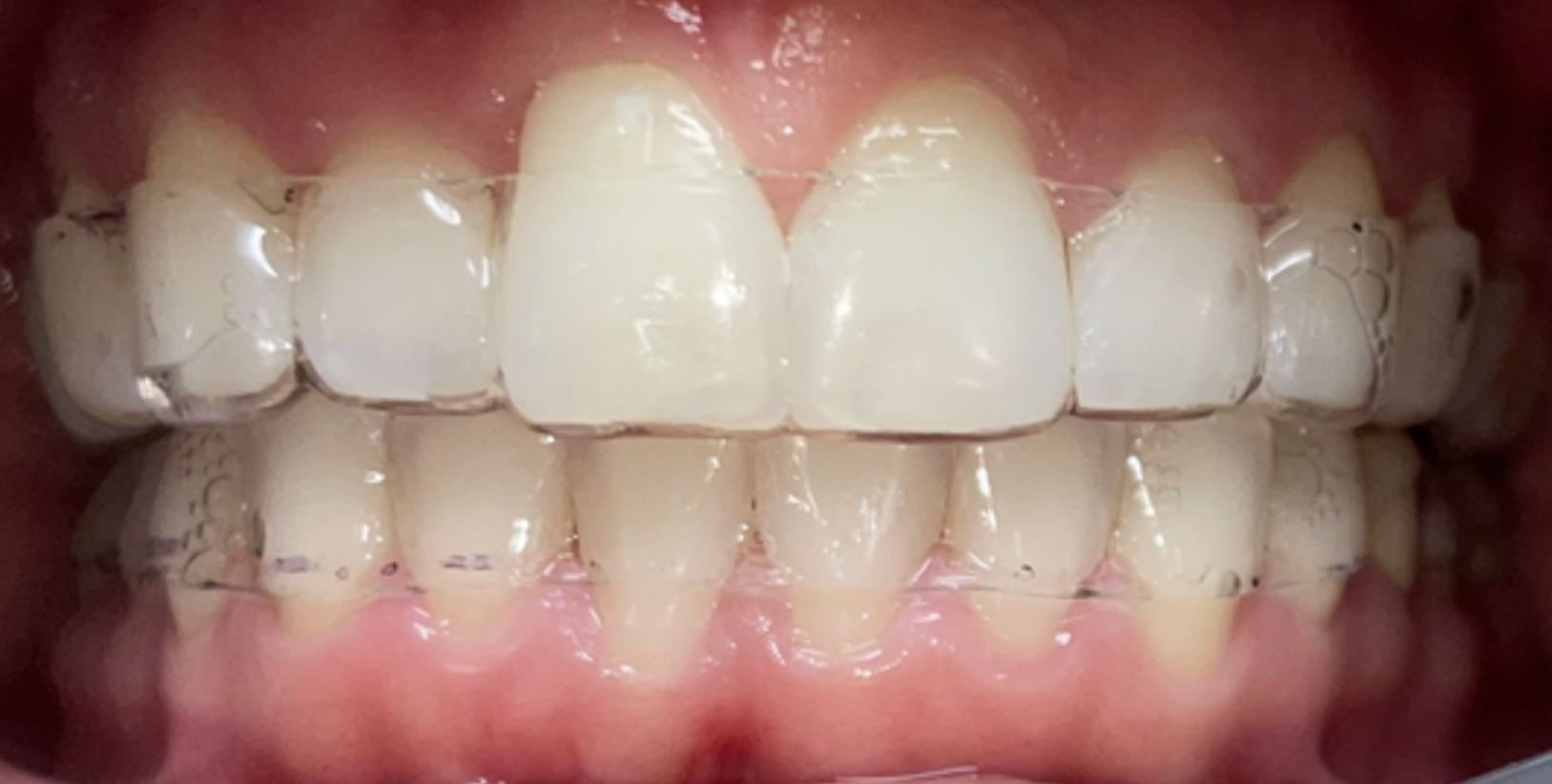 Horizontal Aligner Trims – CandidPro